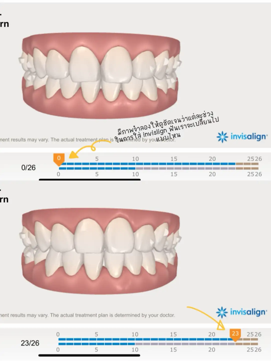 Invisalign Attachments - การค้นหาใน Lemon8