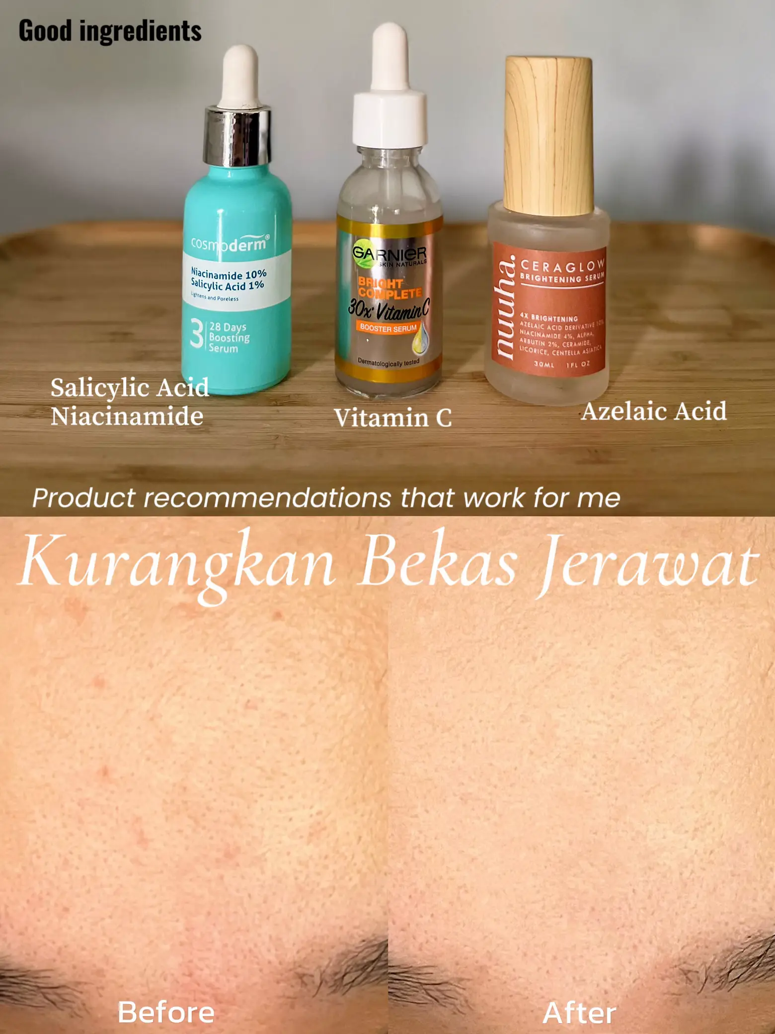 Kurangkan Bekas Parut Jerawat Dengan Products Ni! | Galeri disiarkan ...
