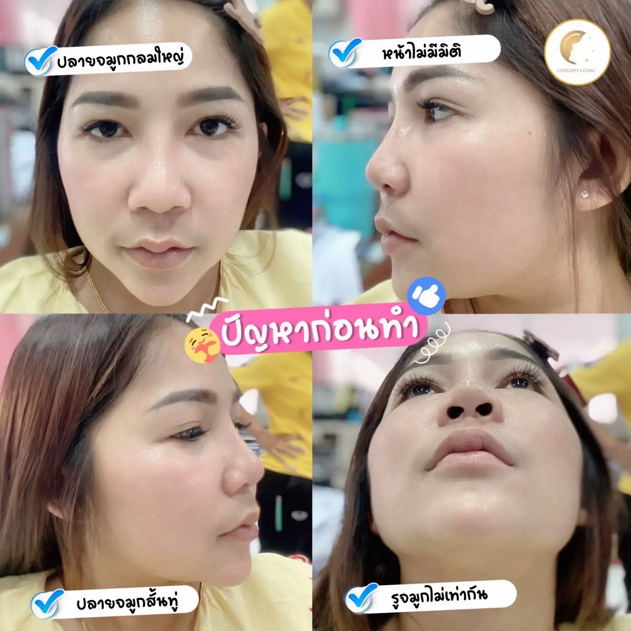 รีวิวพลีชีพ เเก้จมูกโอเพ่นแบบเรียลๆ | แกลเลอรีที่โพสต์โดย Conceptclinic | Lemon8