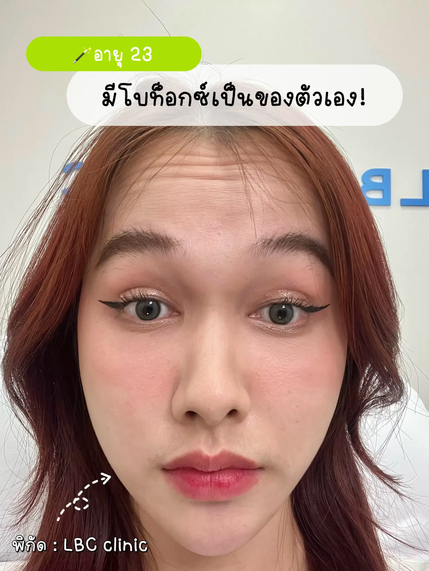 รีวิวโบริ้วรอยรอบที่ 2 ในวัย 23 ปี! | แกลเลอรีที่โพสต์โดย Yean | Lemon8