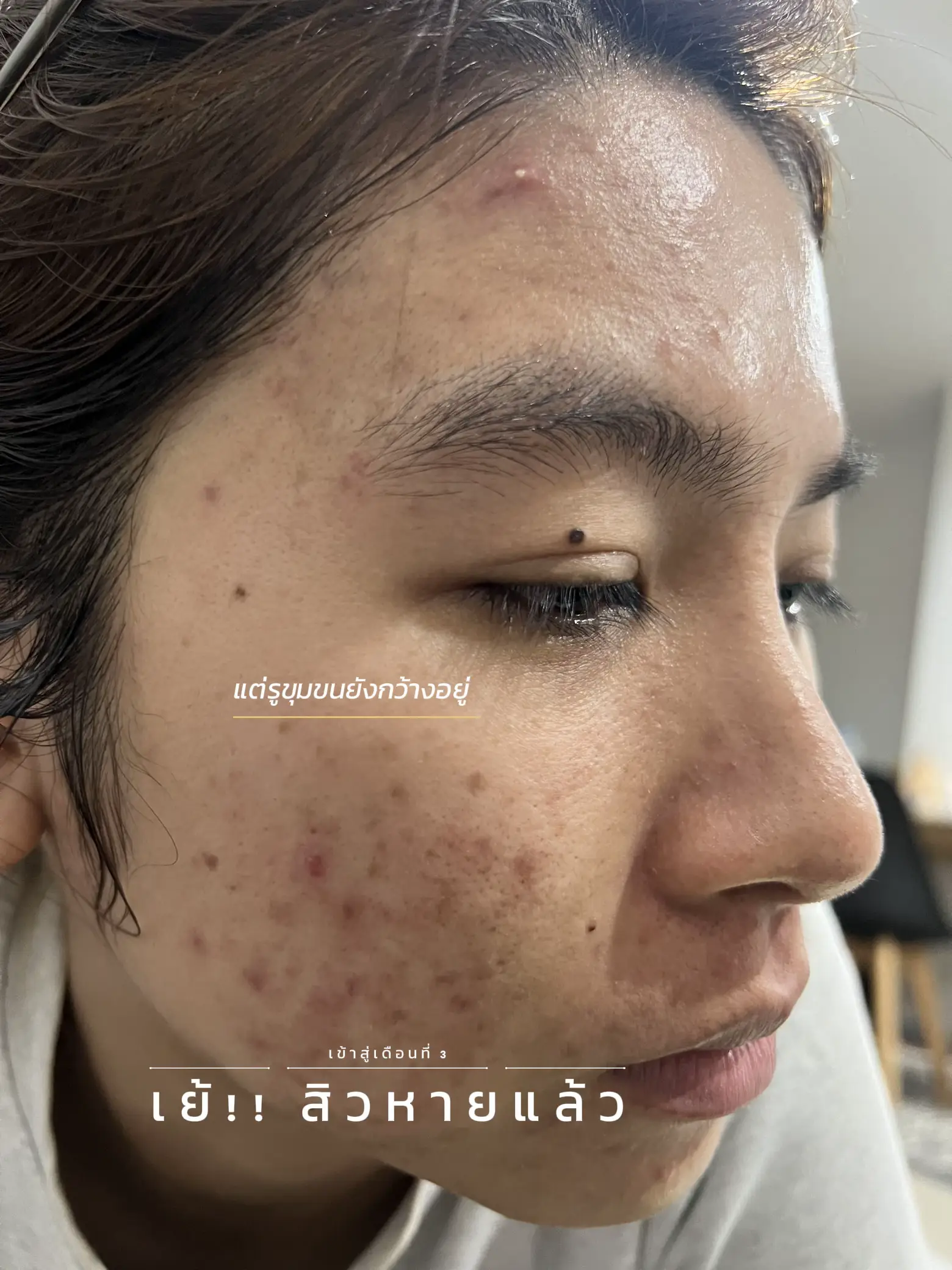 Review การใช้ Retinol แบบของแทร่ | แกลเลอรีที่โพสต์โดย 🐳 | Lemon8