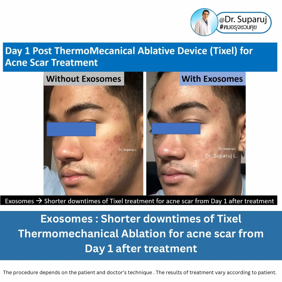 รักษาหลุมสิว Tixel + Exosomes | แกลเลอรีที่โพสต์โดย หมอรุจชวนคุยRuj ...