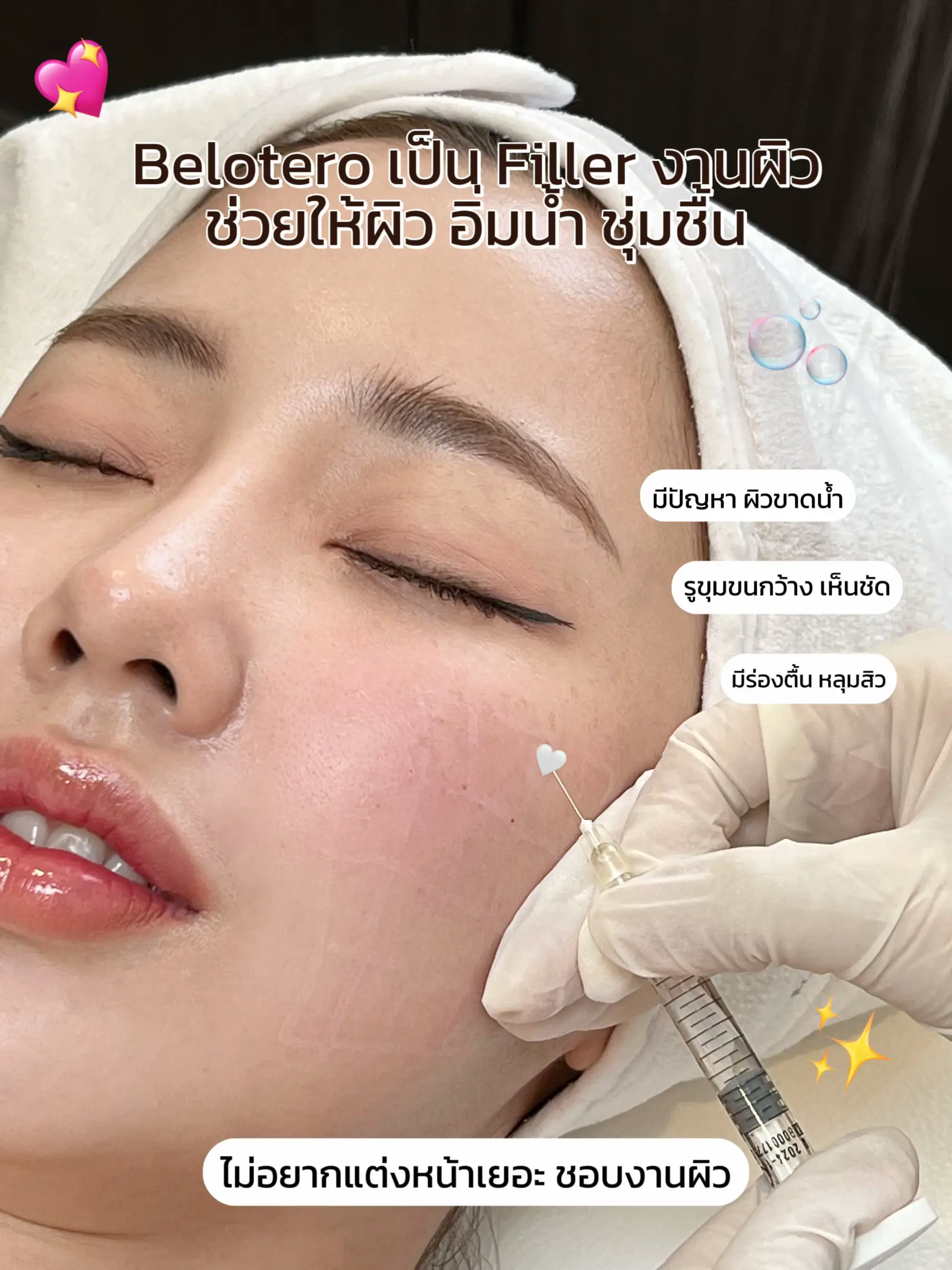 Neobelle Filler - การค้นหาใน Lemon8