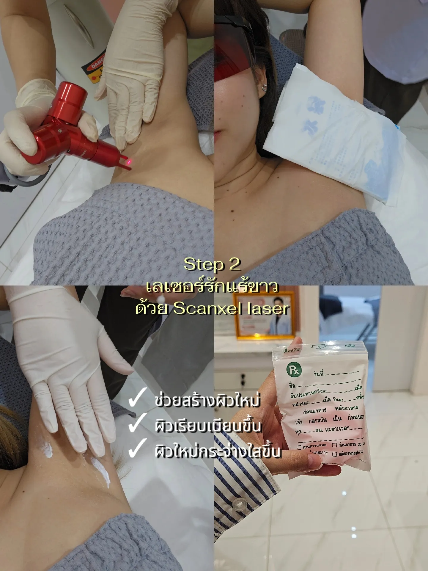 แชร์ประสบการณ์แพ้โรลออน รักแร้ดำมา 17 ปี | แกลเลอรีที่โพสต์โดย Kesinee.K | Lemon8