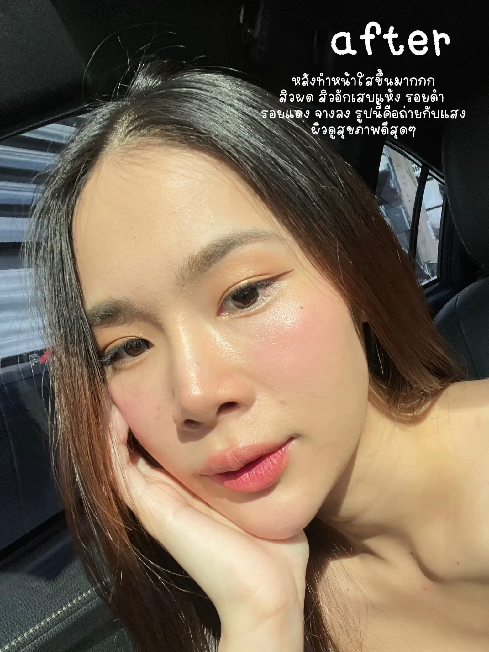 จากหน้าสิว เป็นหน้าใส งบแค่ 2xxx | แกลเลอรีที่โพสต์โดย Name.nv | Lemon8