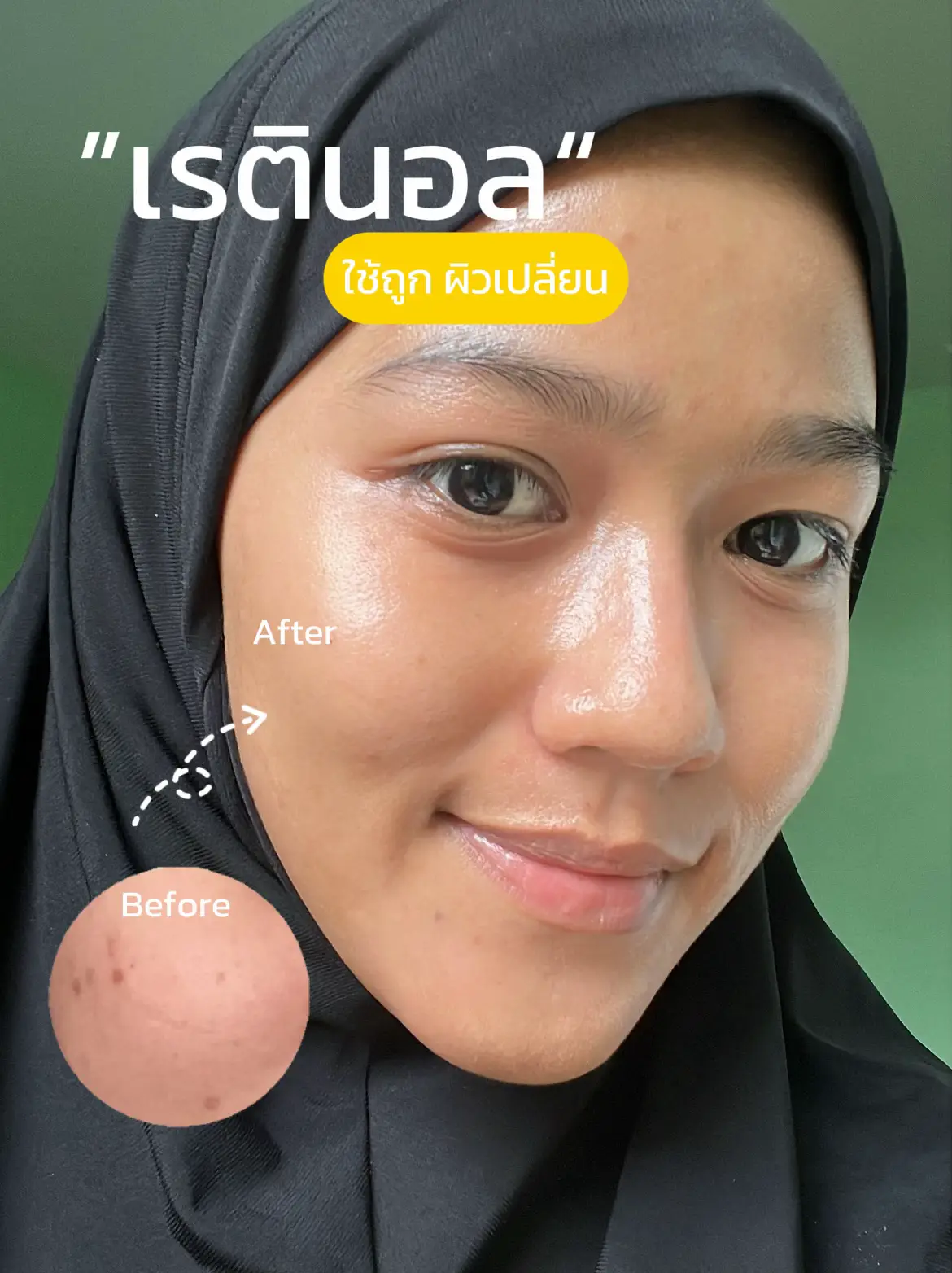 รู้งี้ใช้ตั้งนานแล้ว “เรตินอล” ใช้ถูก ผิวเปลี่ยน | แกลเลอรีที่โพสต์โดย ...