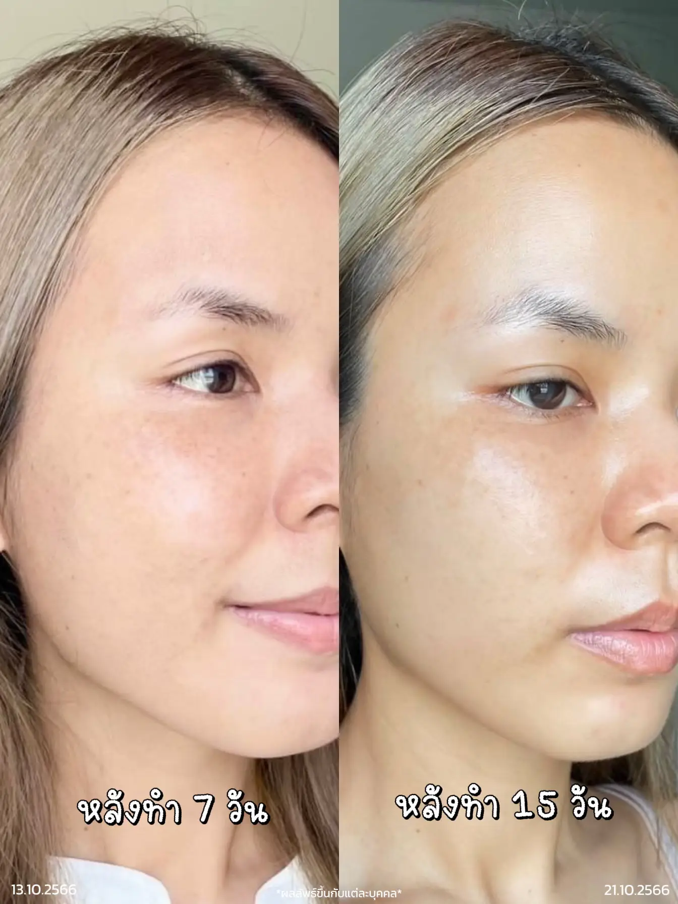 PICO รักษาฝ้ากระได้จริงมั้ย🤔 | แกลเลอรีที่โพสต์โดย wonder girl. | Lemon8