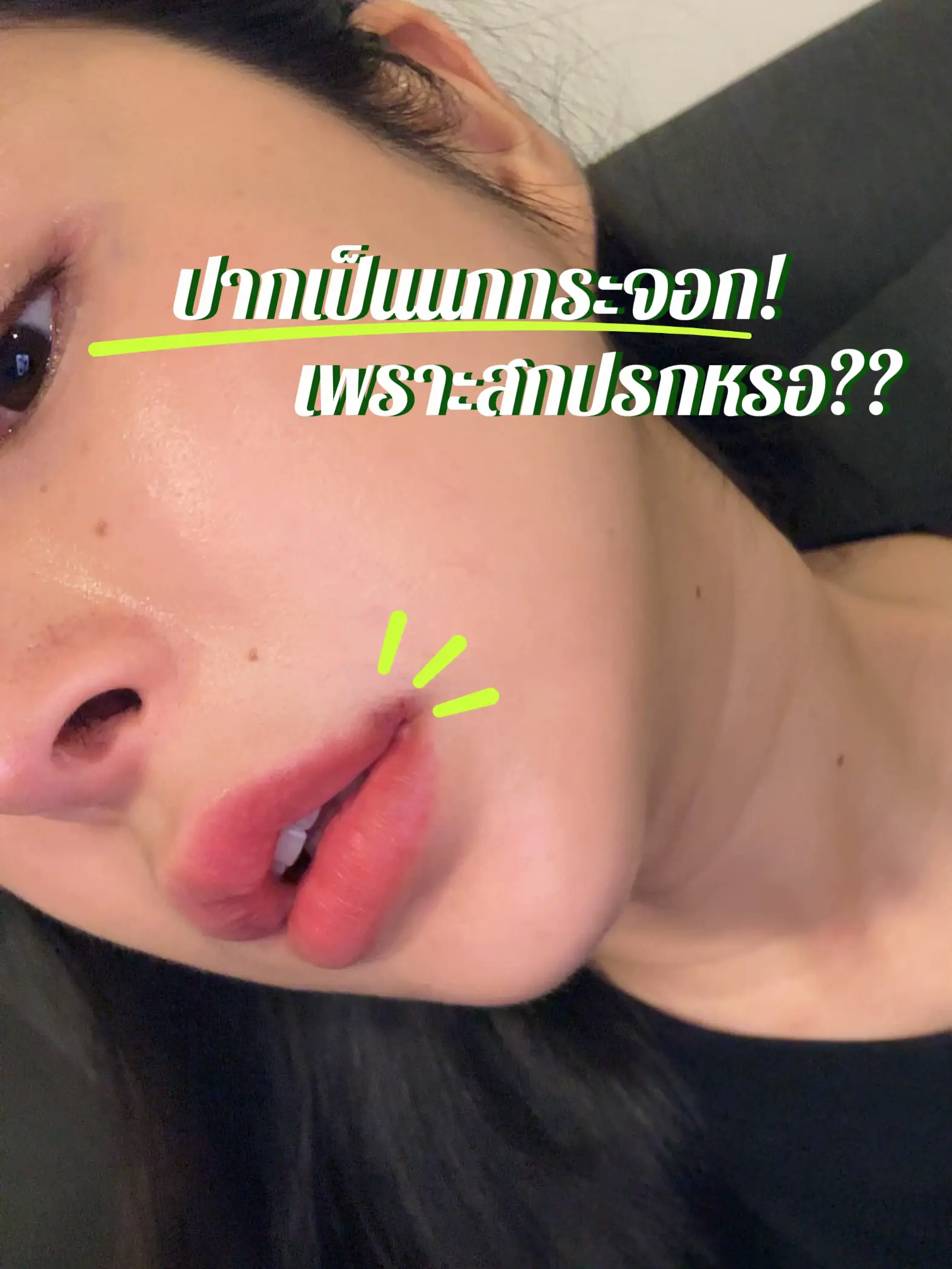 ปากเป็นนกกระจอก! เพราะสกปรกหรอ?? | แกลเลอรีที่โพสต์โดย aum___.aim | Lemon8