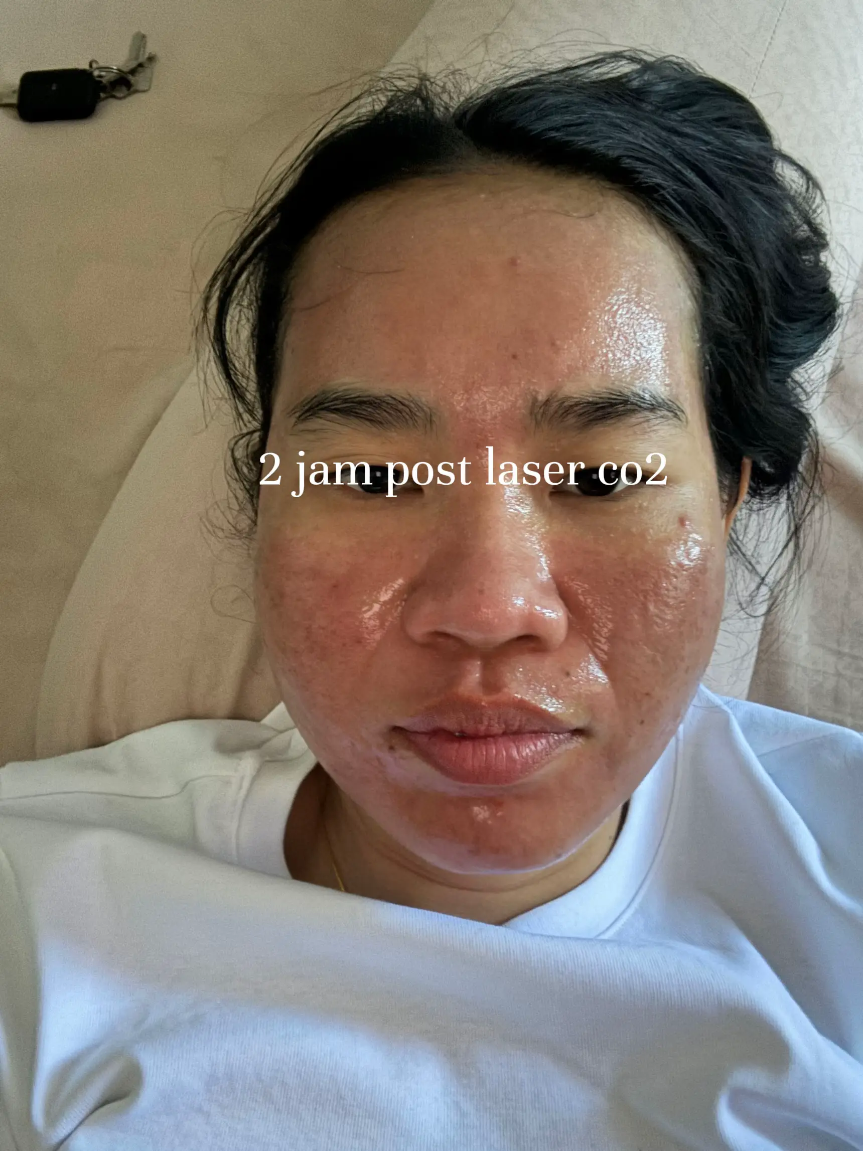 H+10 post laser CO2 | Galeri diposting oleh Juliati Jan | Lemon8