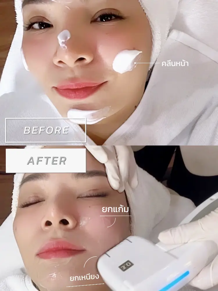 รีวิว Ultramax Hifu - การค้นหาใน Lemon8