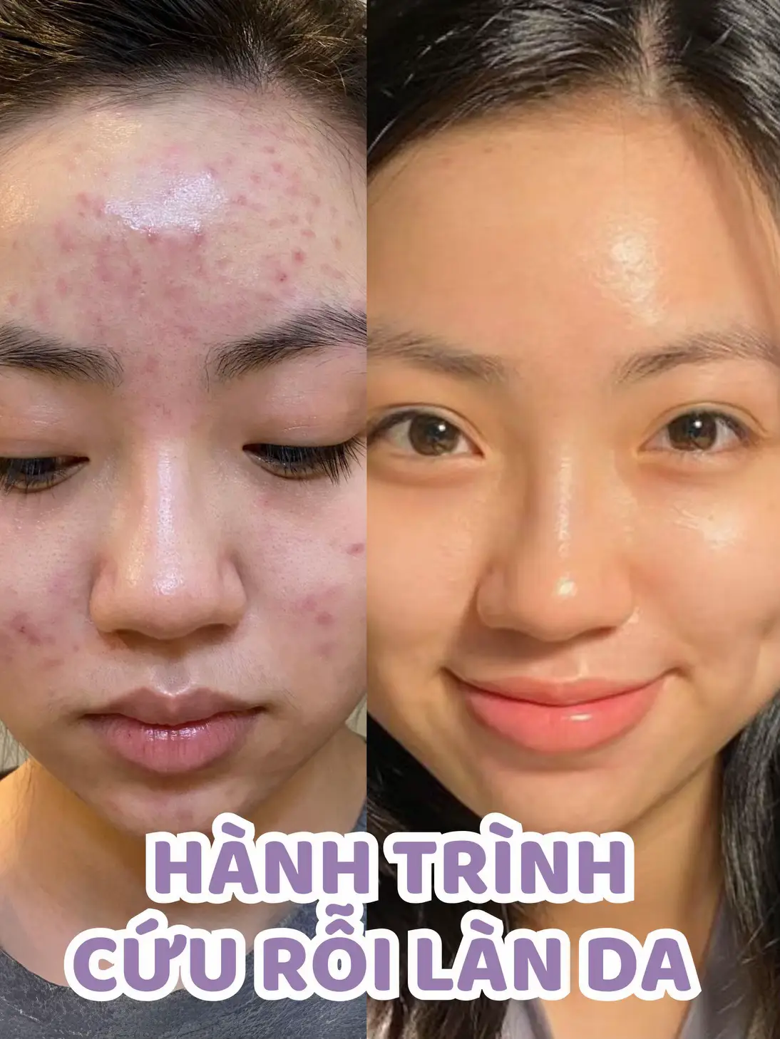 Hành trình cứu rỗi làn da của mình 🥹 | Bộ sưu tập do Trang Lin đăng ...
