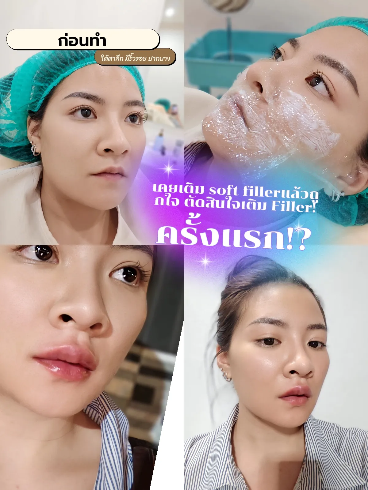 Used to fill the soft filler and liked it. Decided to fill the filler! | Gallery posted by ...