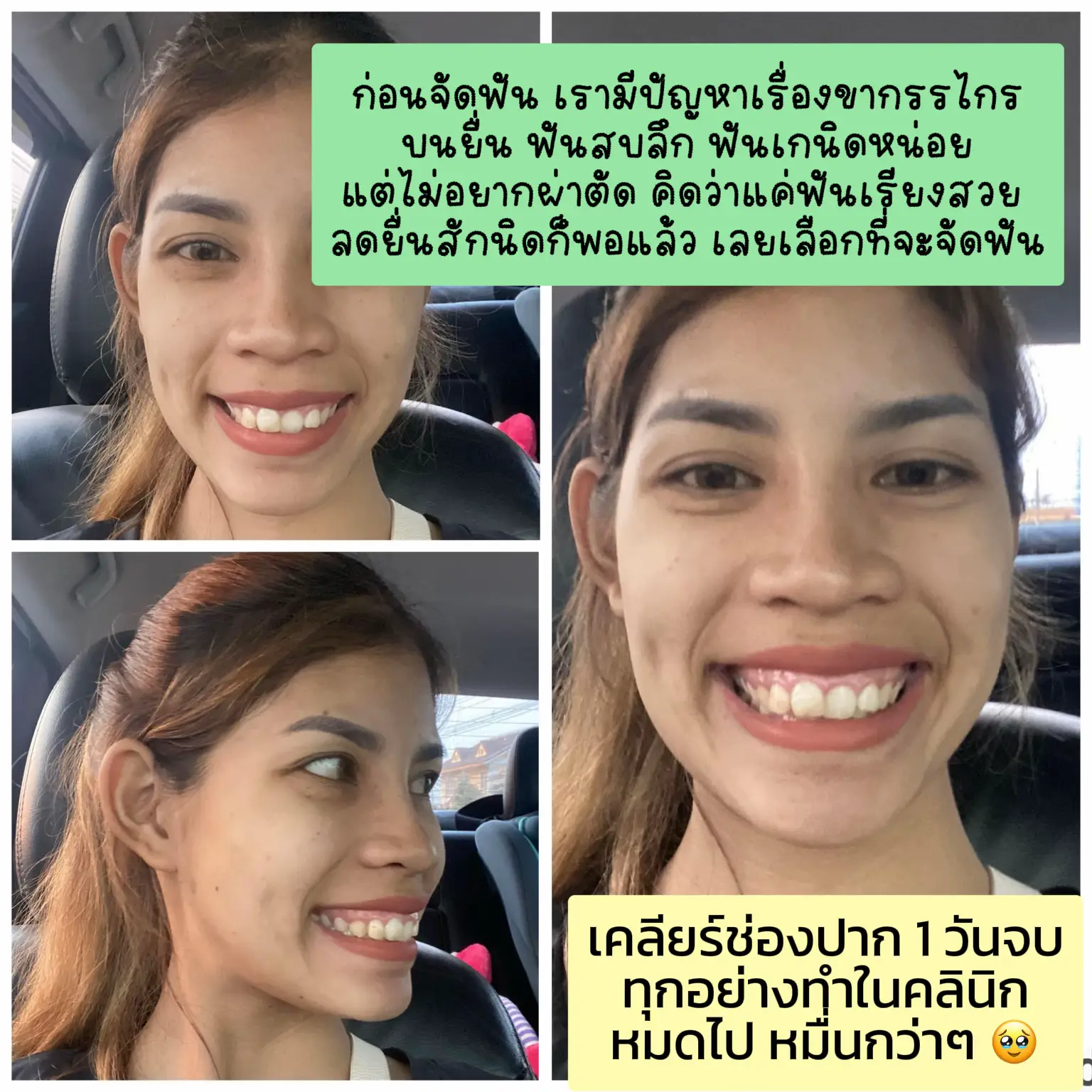 จัดฟันครบ 1 ปีแล้ว มีอะไรเปลี่ยนไปบ้าง? | แกลเลอรีที่โพสต์โดย Ratchaporn Sinm | Lemon8