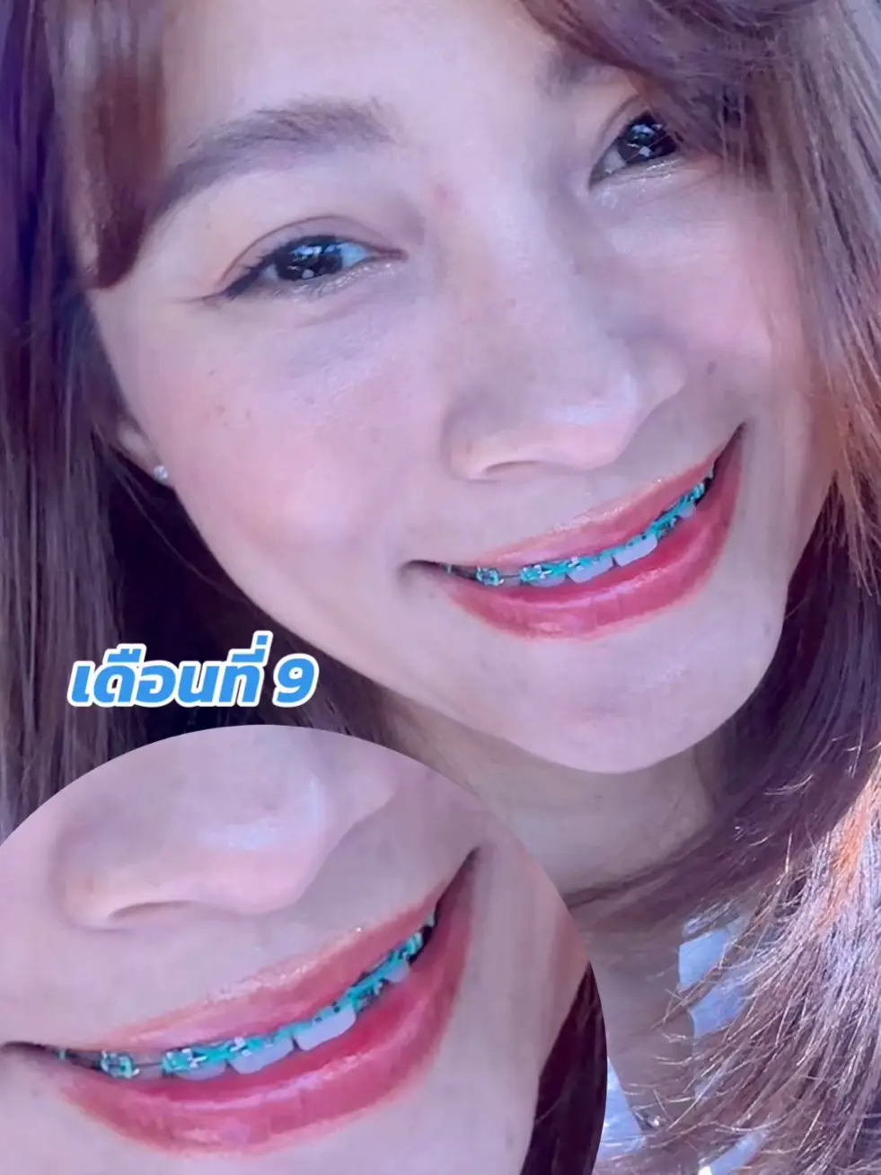 รีวิวจัดฟัน ในวัยเลข4 | แกลเลอรีที่โพสต์โดย Goonggiヅ กุ้งกิ | Lemon8