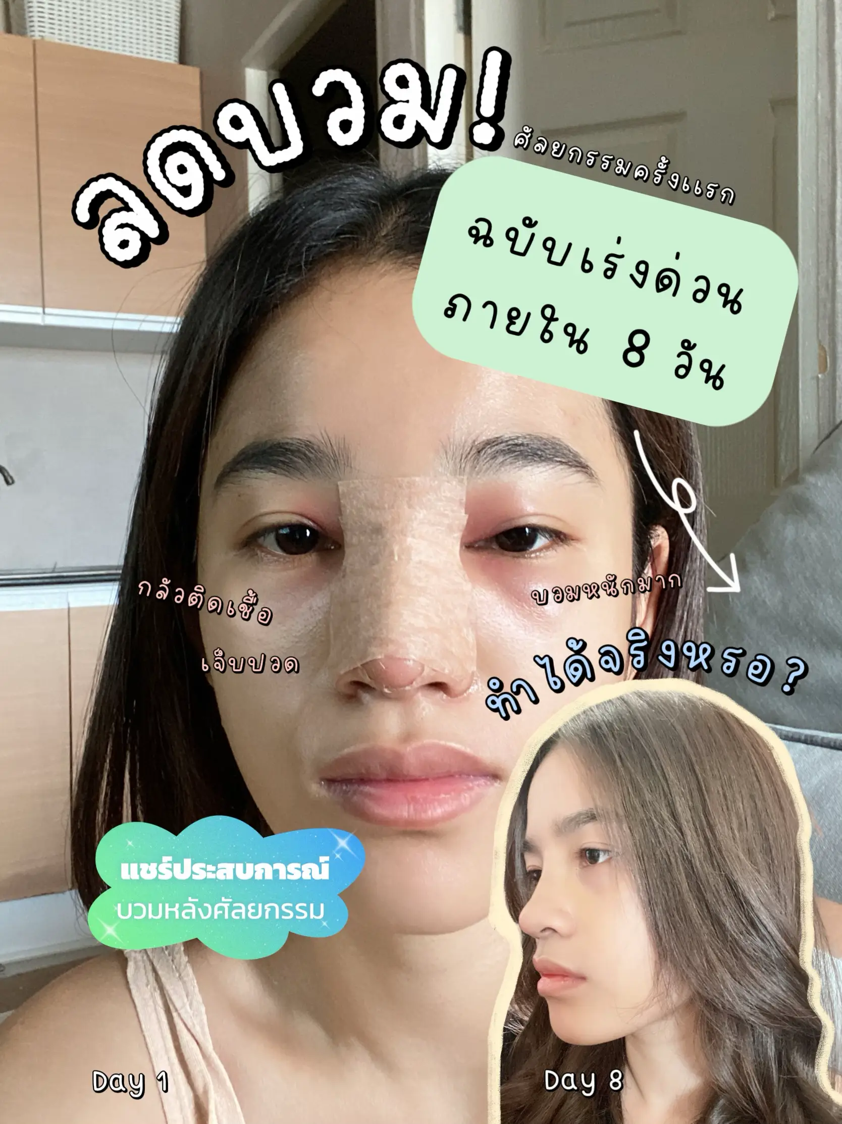 ลดบวม Proctase-P คือ ยา แก้ อะไร - การค้นหาใน Lemon8