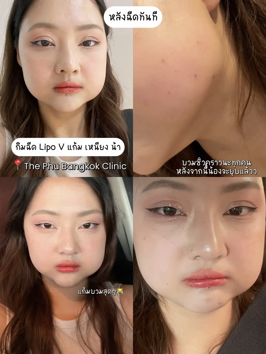 รีวิว Lipo V ฉีดแล้วหน้าลงจริงมั้ย?💖👀 | แกลเลอรีที่โพสต์โดย kimhuai ...