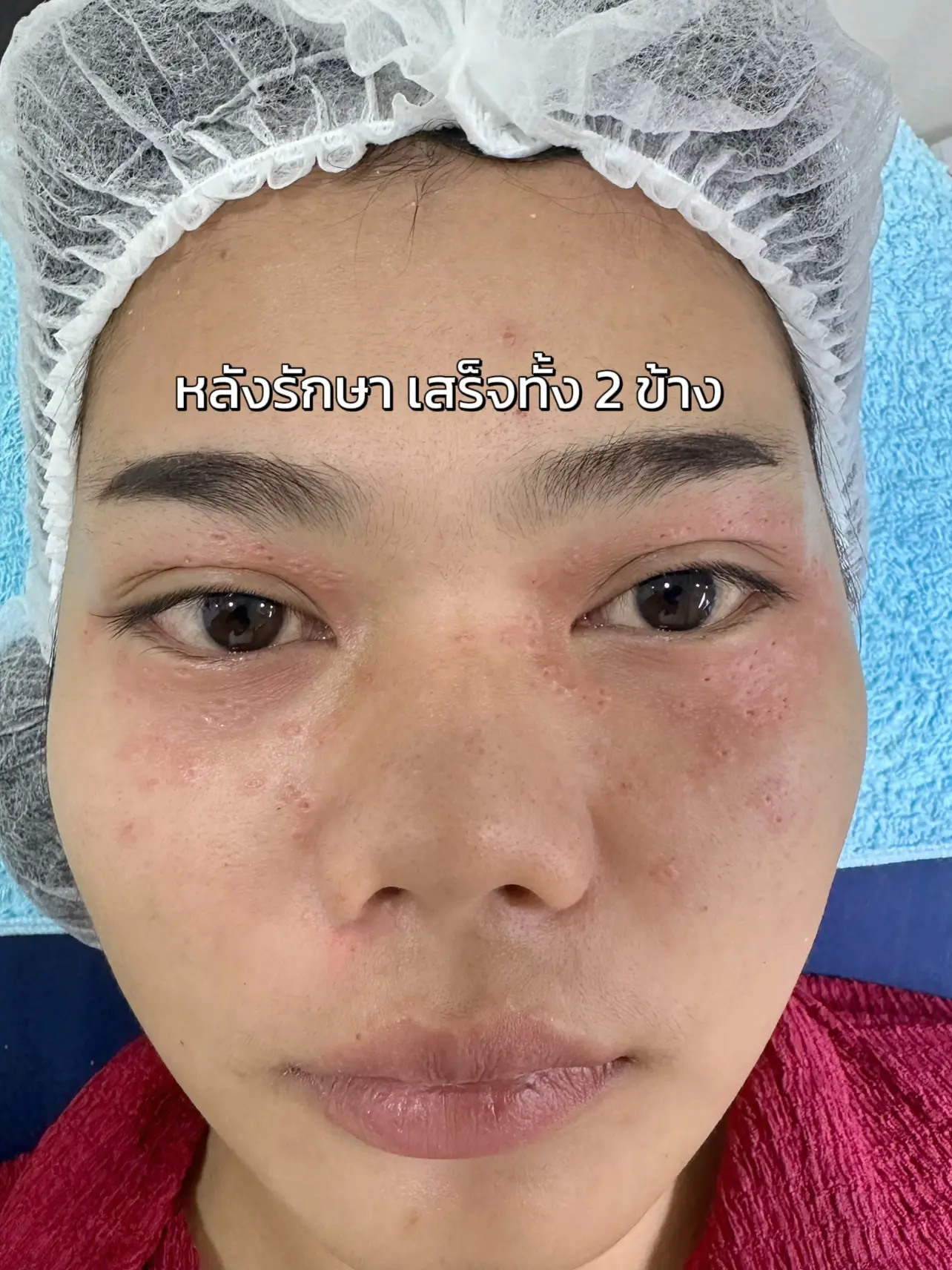กระเนื้อ ต่อมไขมัน หายเกลี้ยงด้วย Co 2 laser 🍋 | แกลเลอรีที่โพสต์โดย Dr.Ploy รุ่งนภา | Lemon8
