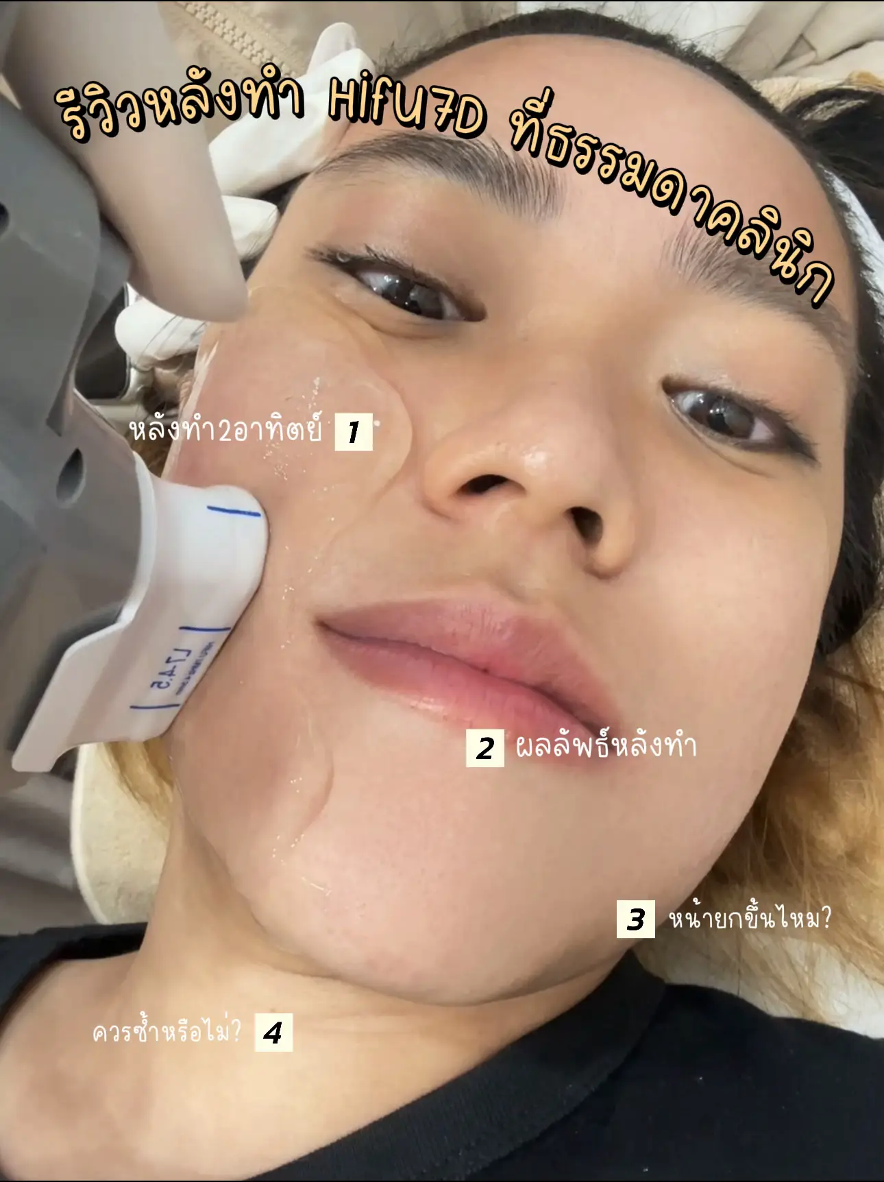 Premium Hifu สองแบ้งค์เทามีทอน เห็นผลจริง😱😱 | แกลเลอรีที่โพสต์โดย ตอเต่าป้ายยา💋👊🏻 | Lemon8