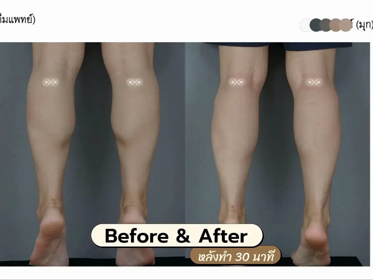 Dream legs at Infinity Clinic หลังทำมา 6 เดือน | แกลเลอรีที่โพสต์โดย ...