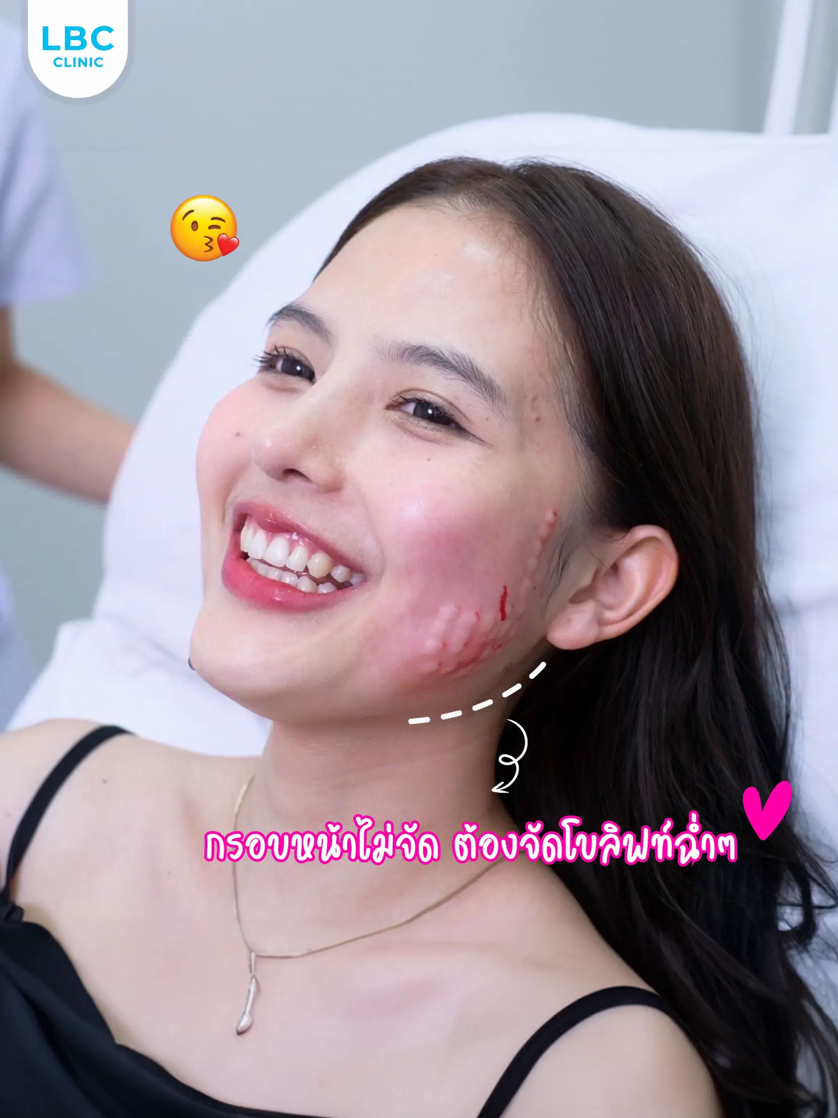 botoxกราม lbc - การค้นหาใน Lemon8