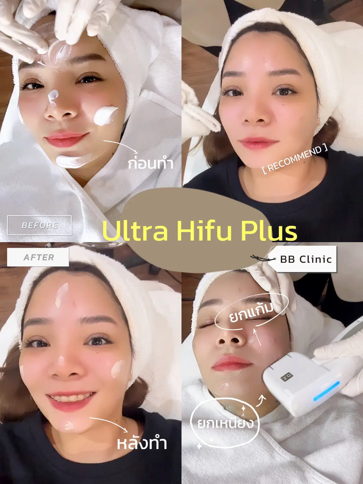 รีวิว Ultramax Hifu - การค้นหาใน Lemon8