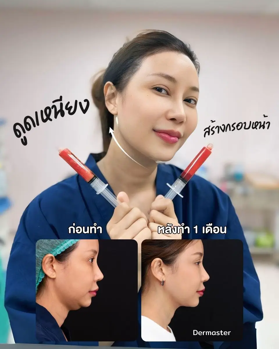รีวิวดูดไขมันเหนียง Dermasrer | แกลเลอรีที่โพสต์โดย @dermaster | Lemon8