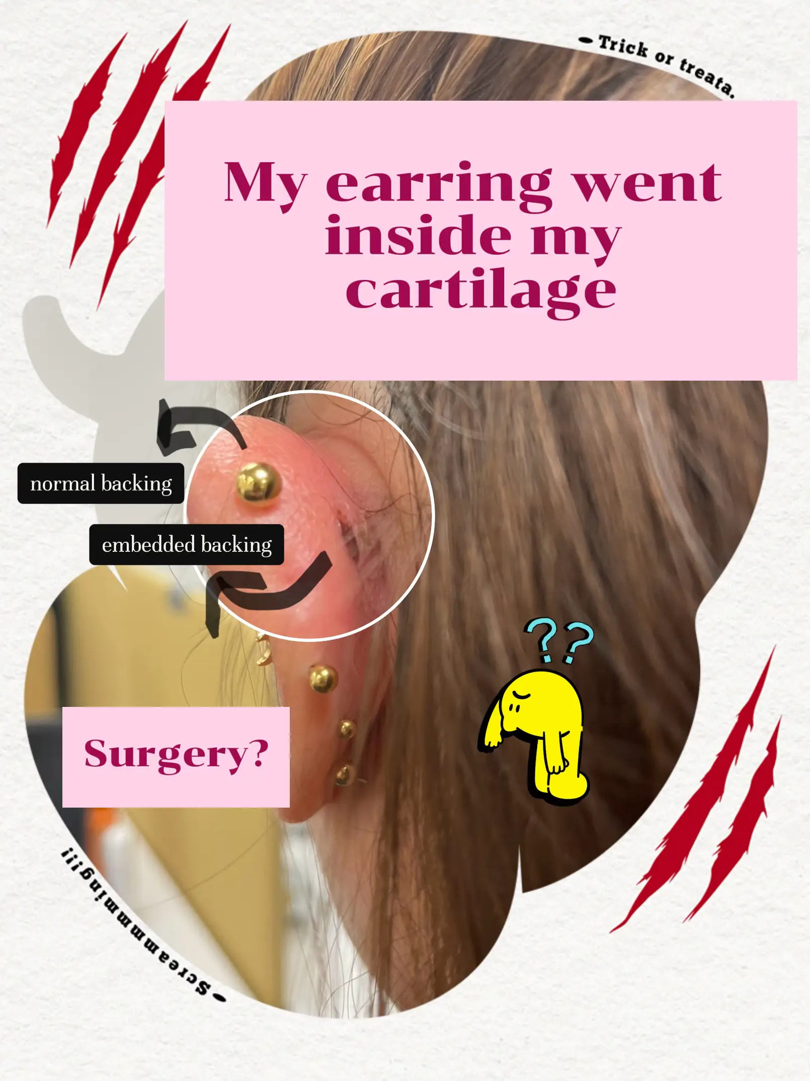 How to deal with an embedded earring 😥 | Gallery posted by ...