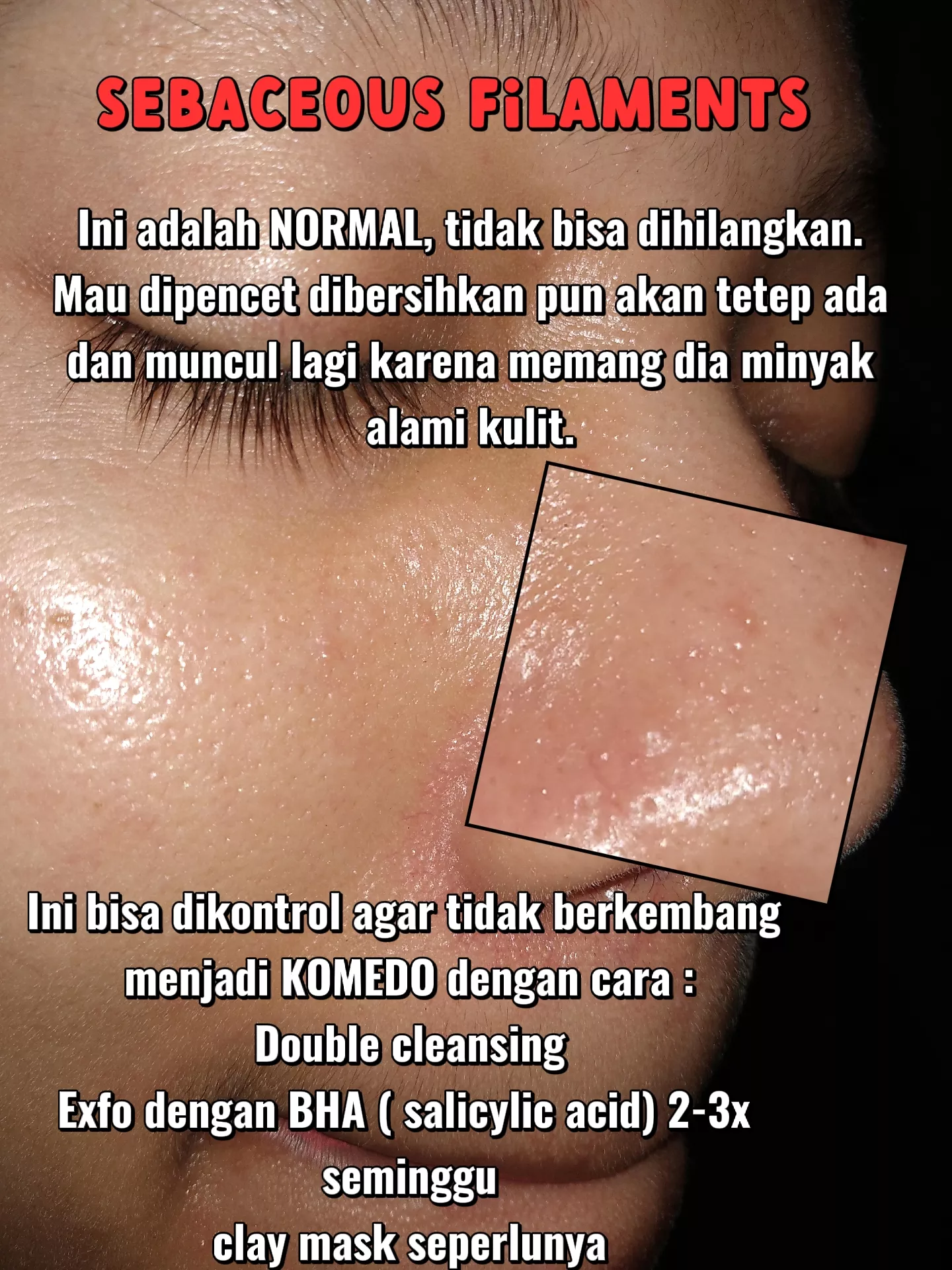 Sebaceous Filaments KOMEDO | Galeri diposting oleh muty | Lemon8