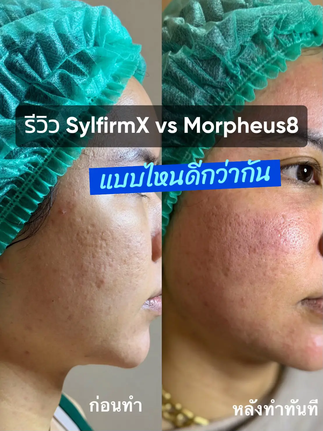 Sylfirm X and Morpheus Reviews Which Hurts More? | Gallery posted by hotmadame 👄 | Lemon8