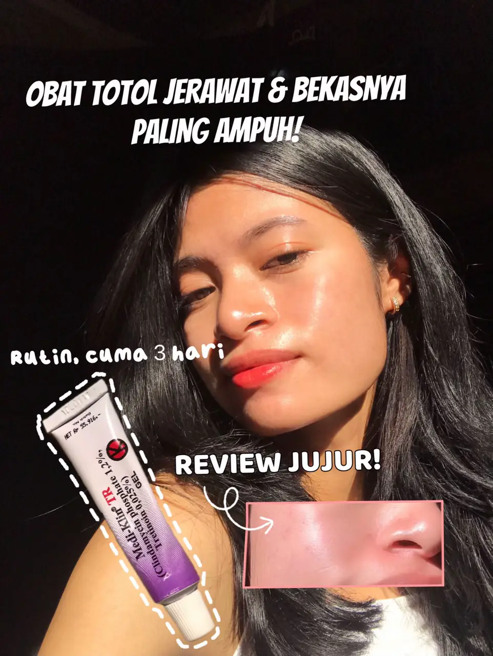 rekomendasi obat bekas jerawat - Pencarian Lemon8