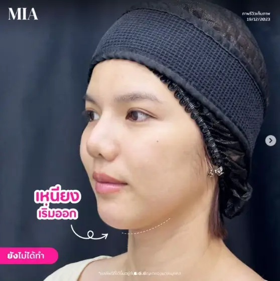 🍁 เหนียงเริ่มออก ให้มาทำ HIFU !! 🍁 | แกลเลอรีที่โพสต์โดย MIA รีวิว | Lemon8