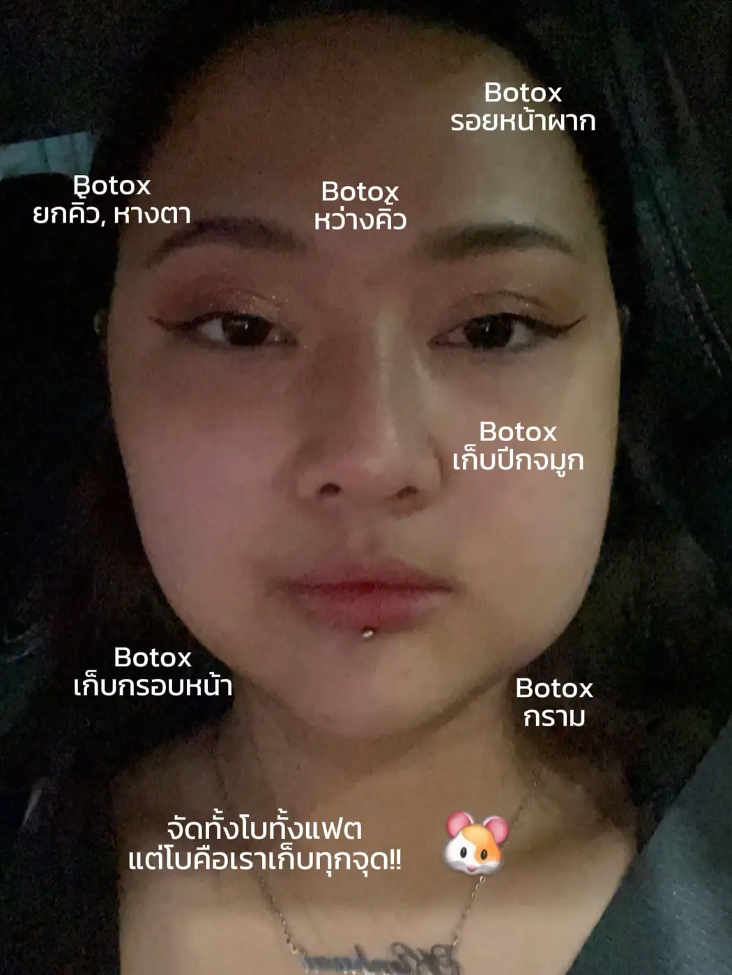 Botox แต่ละจุดควรใช้กี่ยูนิต?| โฆษณาเกินจริงที่ต้องรู้ก่อนโดนหลอก | แกลเลอรีที่โพสต์โดย Kkacha ...