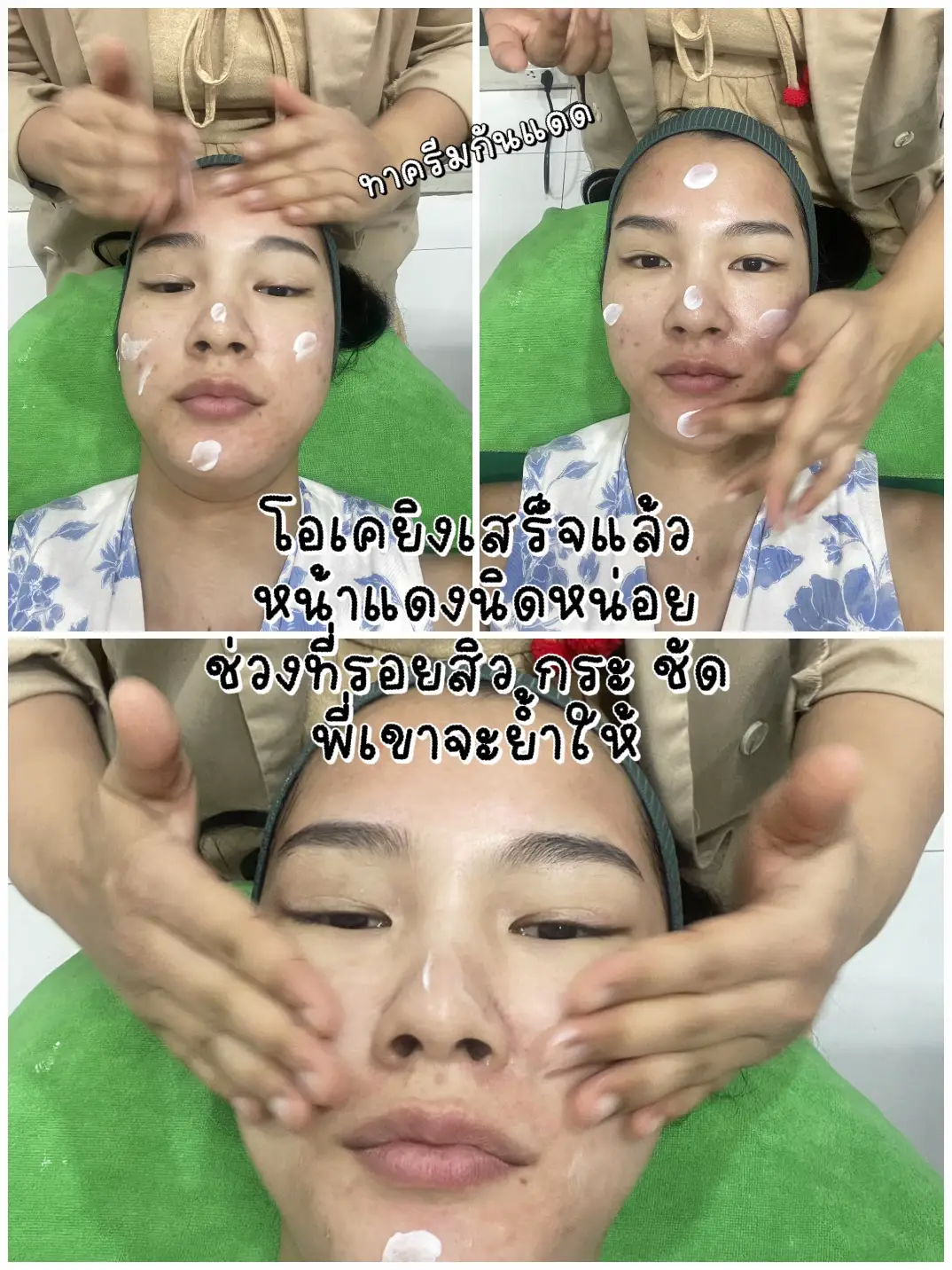 Pico laser 999.- !! เห็นผลแค่ไหน (รีวิวแบบละเอียด) | แกลเลอรีที่โพสต์ ...