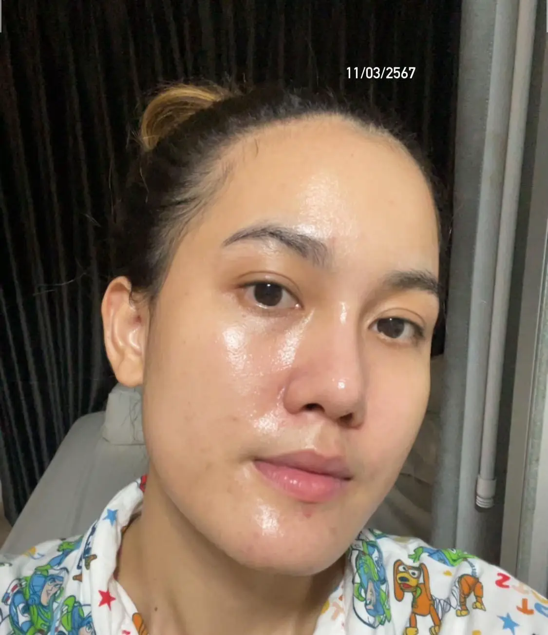 รักษาสิวเอง EP1 (แบบ100%) | แกลเลอรีที่โพสต์โดย Seryoung sp | Lemon8