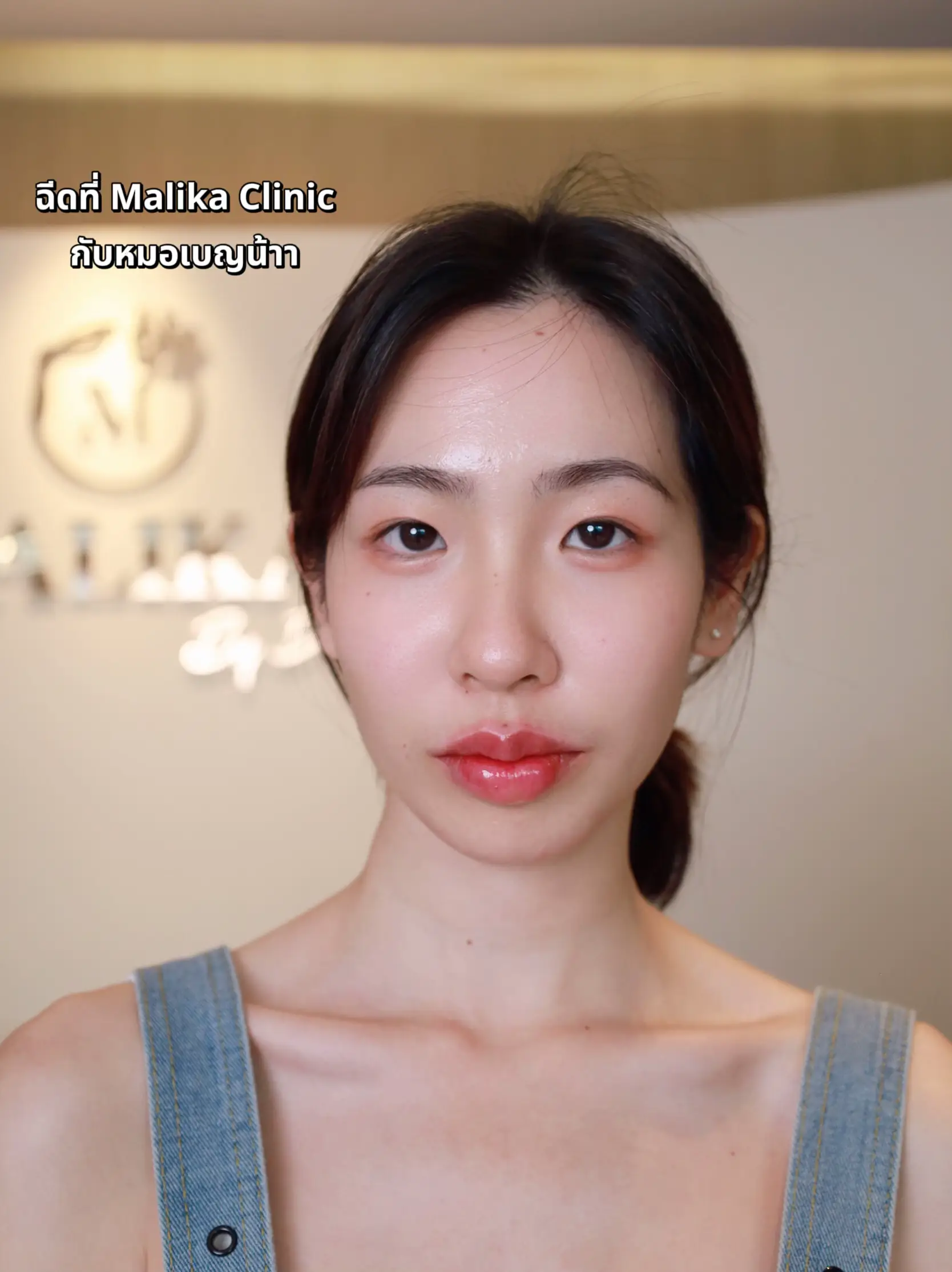 韓国式のマウスフィラーを注入して、このクリニックを見逃さないでください。 📌 | Malika Clinicが投稿したフォトブック | Lemon8