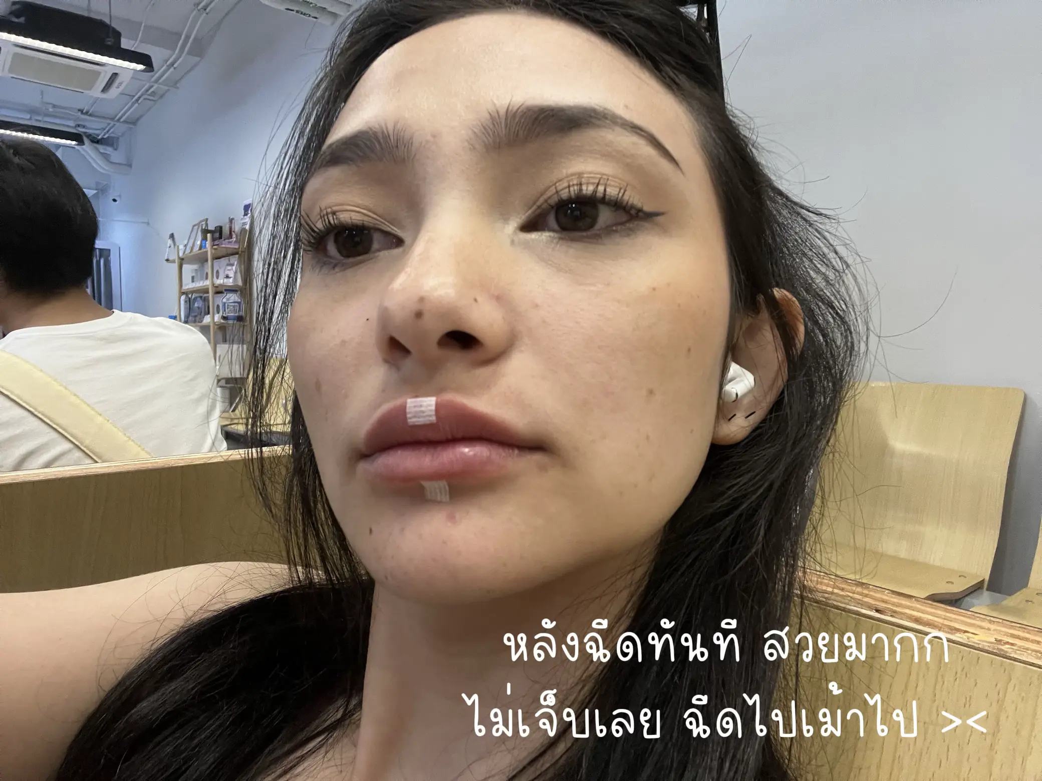 รีวิวทำหัตถการครั้งแรก (ฉีดปาก) ที่ธรรมดาคลินิก | แกลเลอรีที่โพสต์โดย Sofia H. | Lemon8