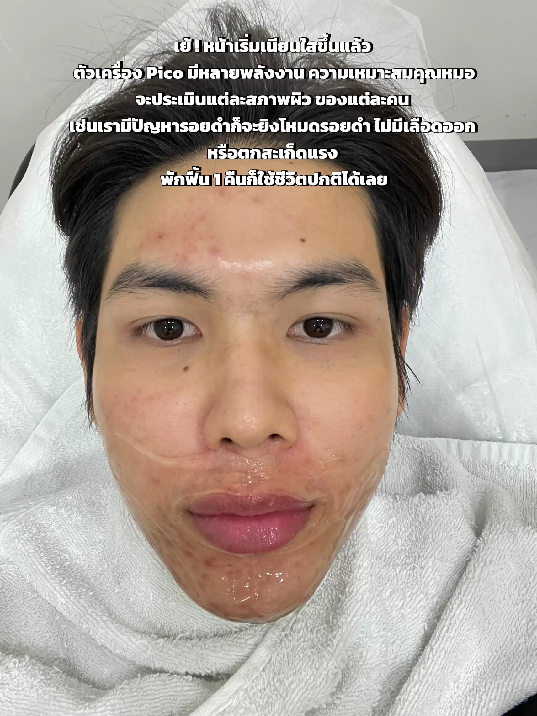 รีวิว PICO LASER รักษารอยดำจากสิว กับ Blossom Clinic | แกลเลอรีที่โพสต์ ...
