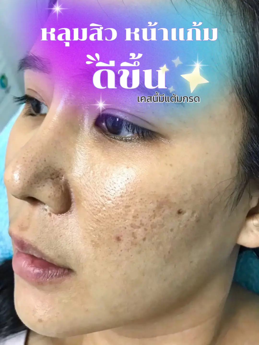 หลุมสิวแบบนี้เห็นผลลัพธ์ รักษาไป 2 ครั้ง | วิดีโอที่เผยแพร่โดย Dr.Ploy รุ่งนภา | Lemon8