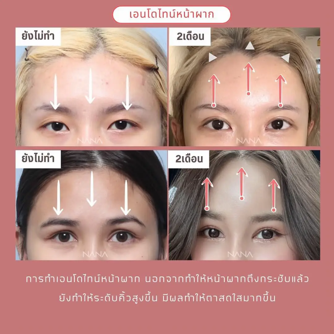 อย่าเพิ่งทำตา หากยังไม่รู้จัก Endotine(ยกหน้าผาก) | แกลเลอรีที่โพสต์โดย Noom BTF | Lemon8