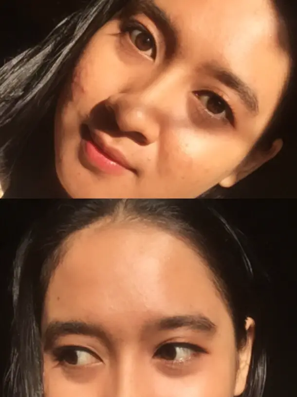 Bersyukur jerawat dah mau ilang | Galeri diposting oleh Imass | Lemon8