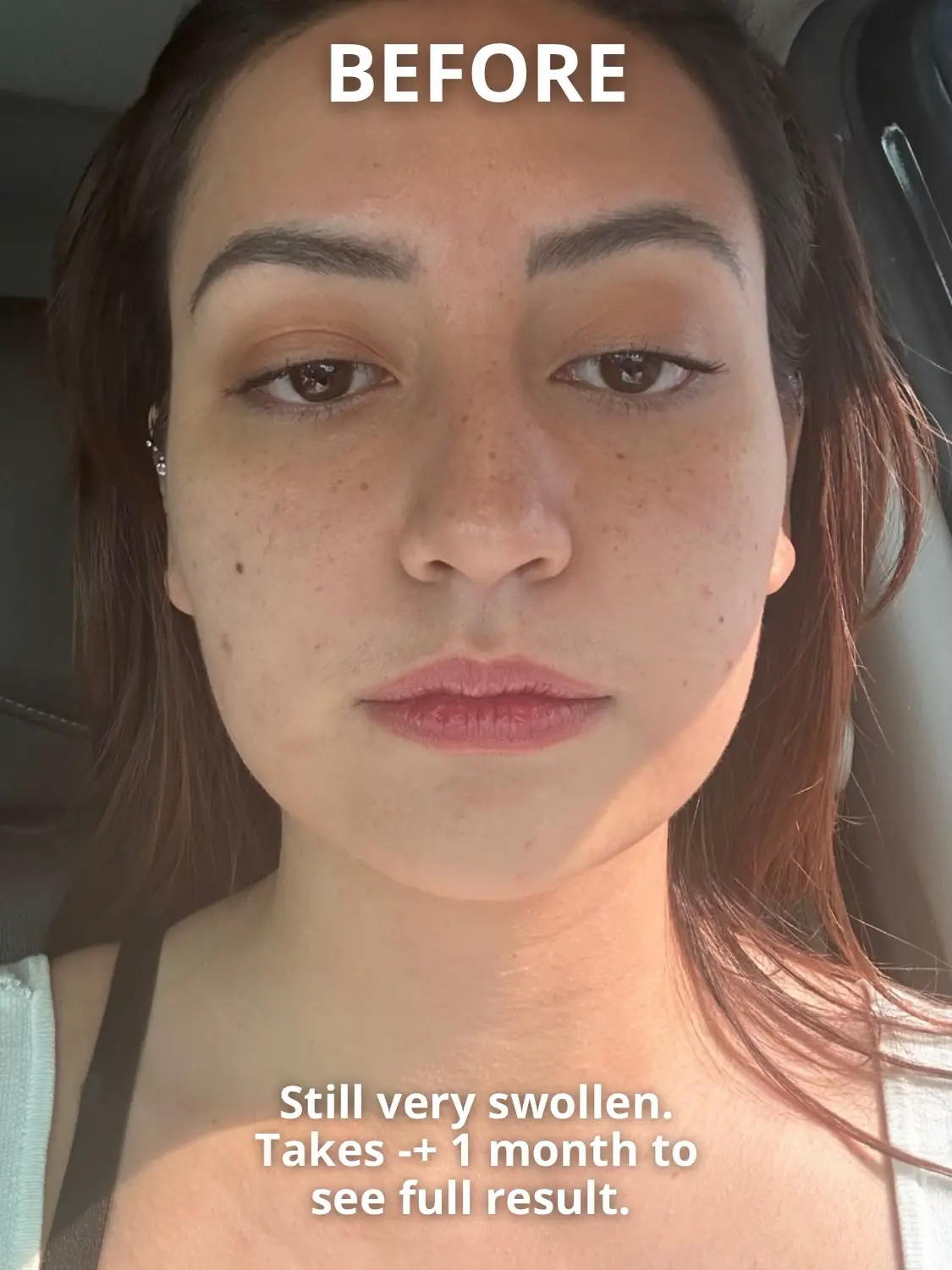 BOTOX RAHANG REVIEW AND RESULT! 🤩 | Galeri diposting oleh mutiarahazle ...