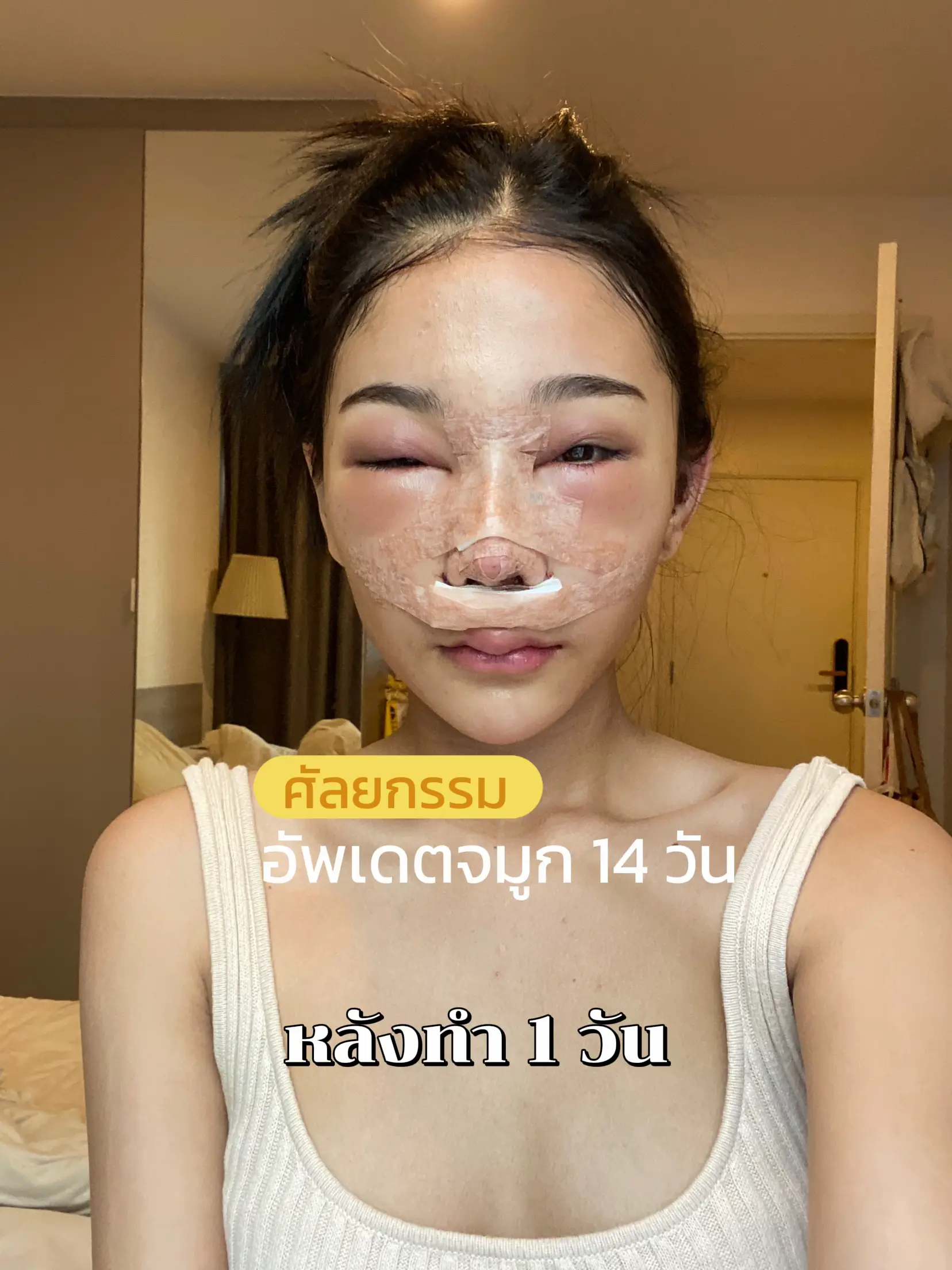 ศัลยกรรมครั้งแรกในชีวิต ปังหรือพัง ‼️ | แกลเลอรีที่โพสต์โดย Nu Dee🐰 | Lemon8