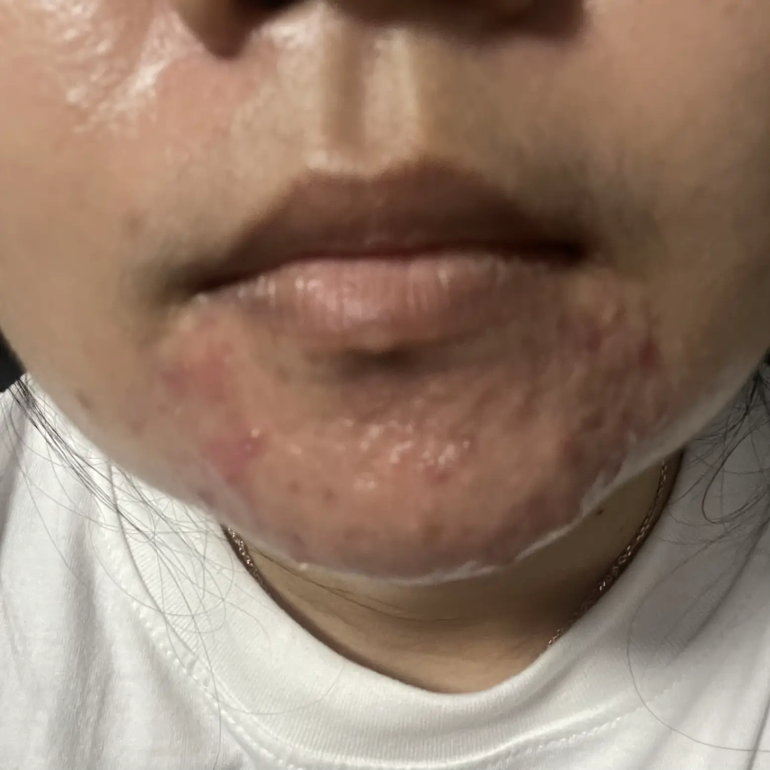 #ช่วยด้วยค่ะสิวแบบนี้รักษายังไงดี | แกลเลอรีที่โพสต์โดย phcrpn_beau ...