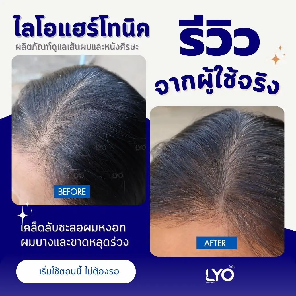 รีวิวจากผู้ใช้จริง Lyo Hair Tonic พิสูจน์มาแล้วว่าได้ผลจริง! | แกลเลอรีที่โพสต์โดย Step Healthy🌱 ...