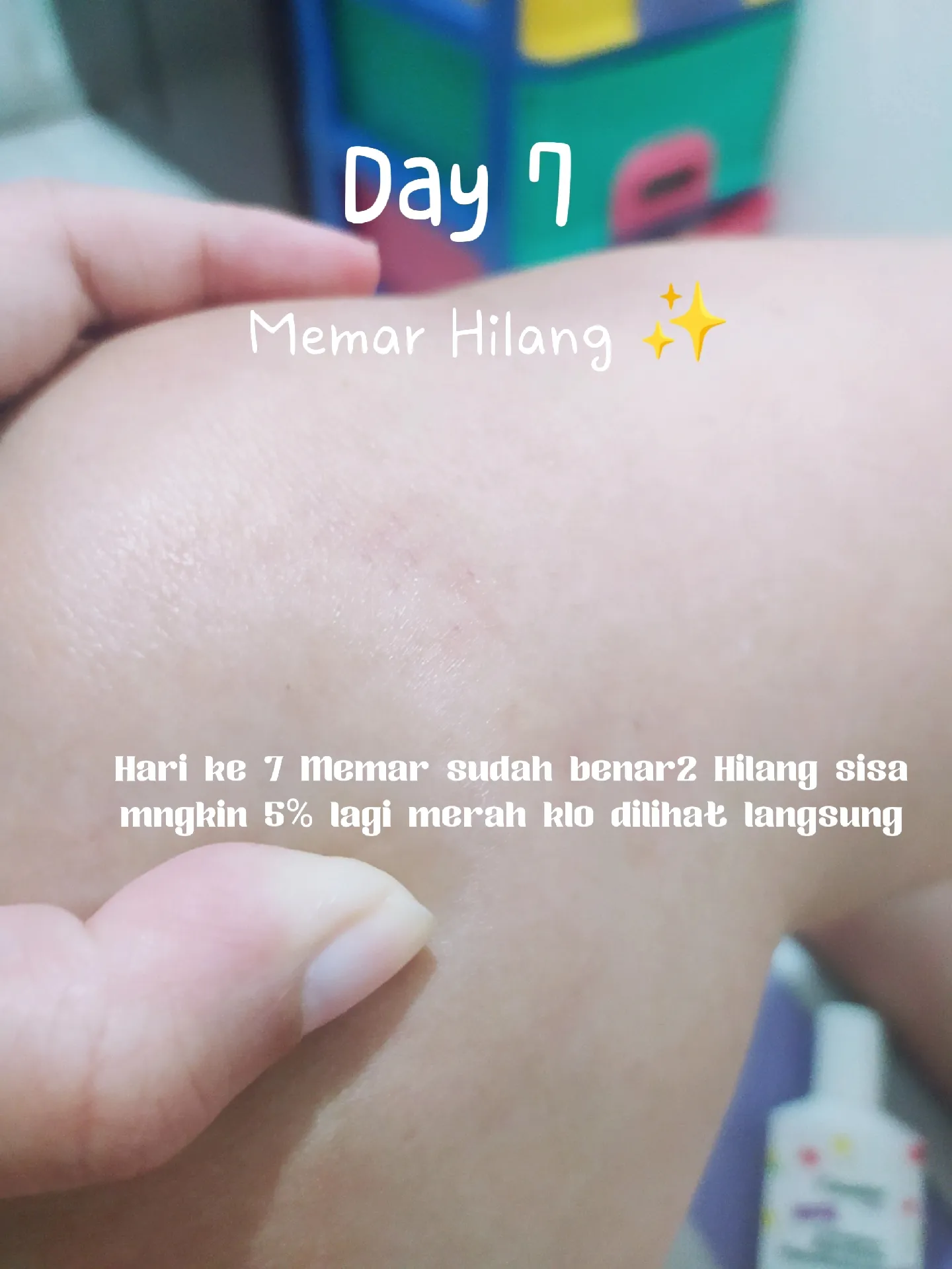 Cara Hilangkan Lebam & Memar Cuma 6 Hari 1 Produk | Galeri diposting ...