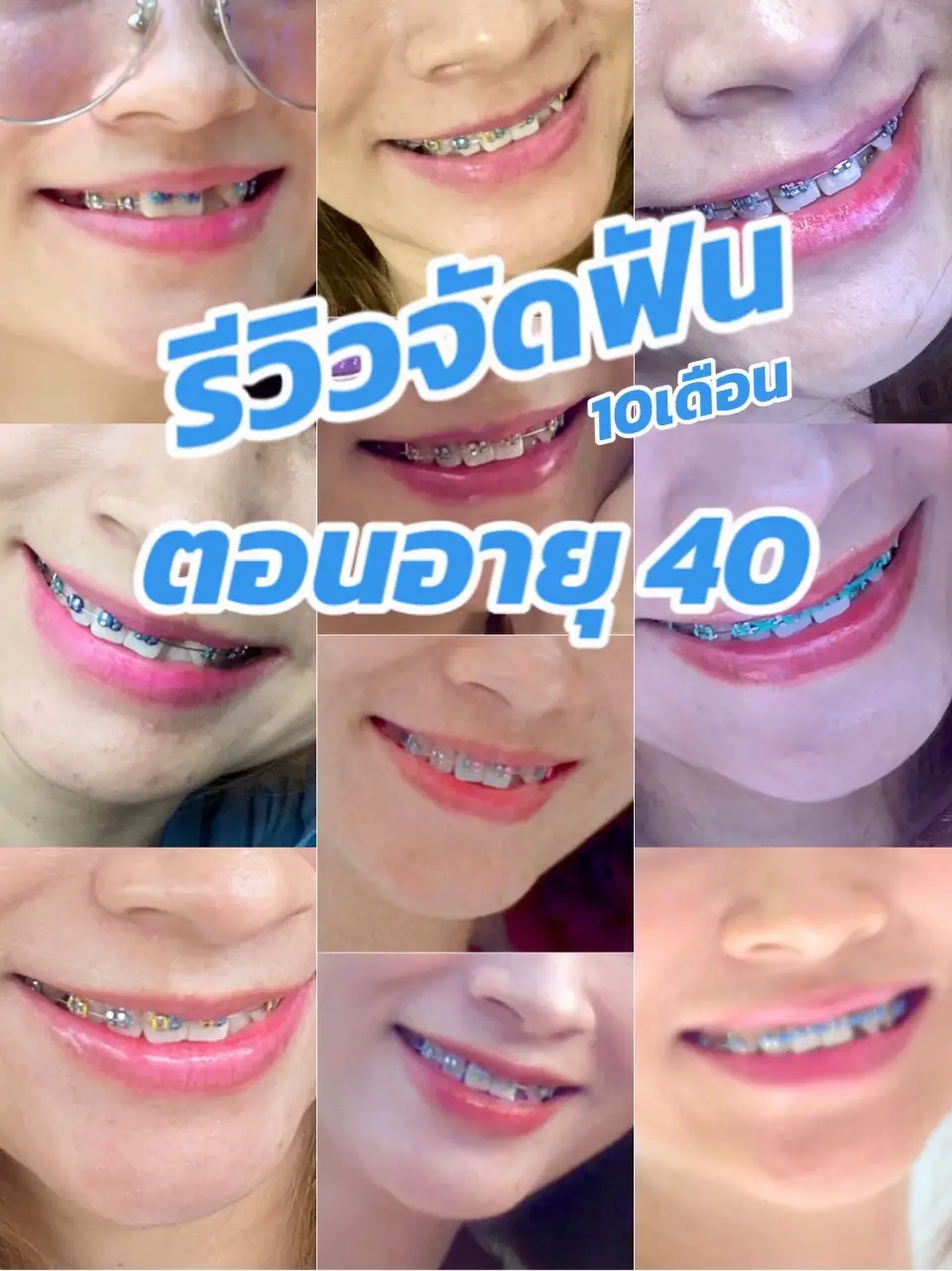 รีวิวจัดฟัน ในวัยเลข4 | แกลเลอรีที่โพสต์โดย Goonggiヅ กุ้งกิ | Lemon8