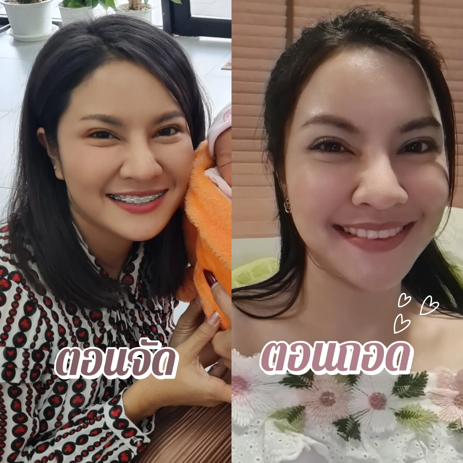 เย้ ถอดเหล็กจัดฟันแล้ว | แกลเลอรีที่โพสต์โดย Lita Patchaya | Lemon8