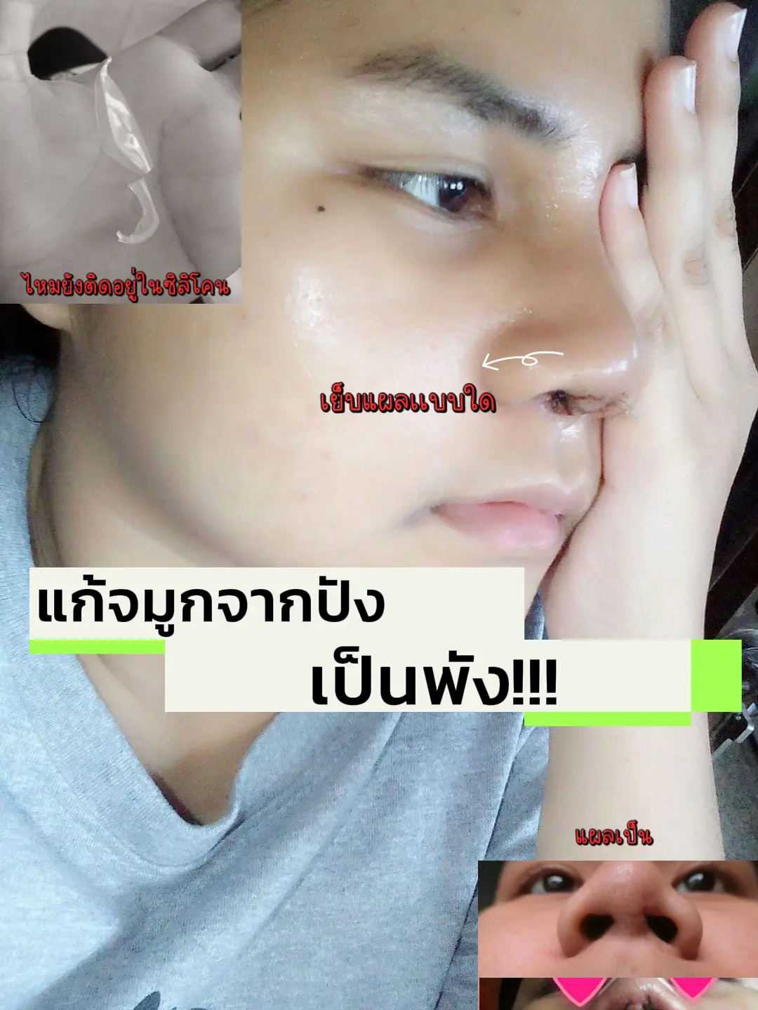 แก้จมูกจากปัง เป็นพัง!!! | แกลเลอรีที่โพสต์โดย Watcharin Noot | Lemon8