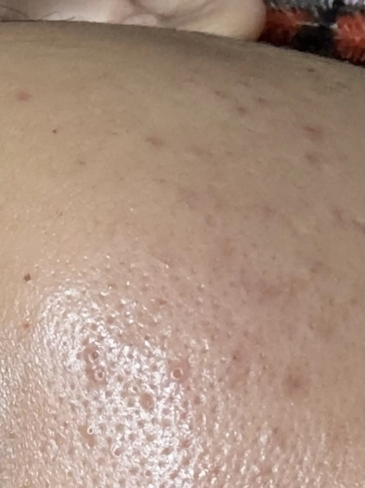 ผลจากการใช้ Acnitin-a +มอย มอยเจอไรเซอร์ cerave | แกลเลอรีที่โพสต์โดย ...