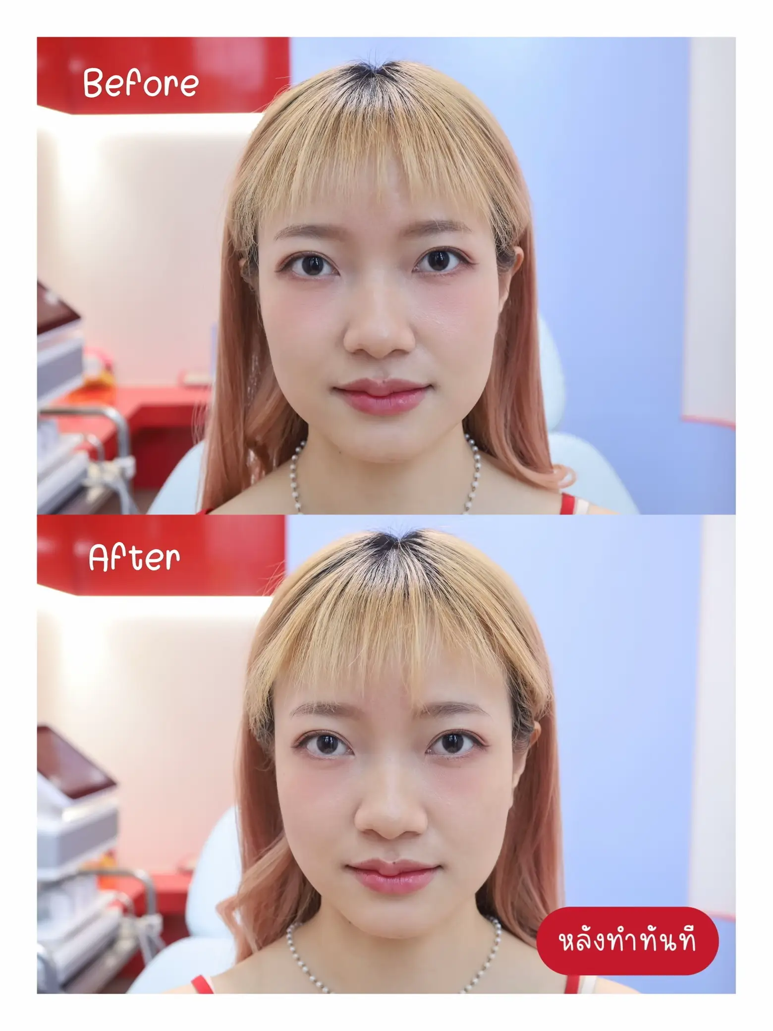 Premium Hifu สองแบ้งค์เทามีทอน เห็นผลจริง😱😱 | แกลเลอรีที่โพสต์โดย ตอเต่าป้ายยา💋👊🏻 | Lemon8